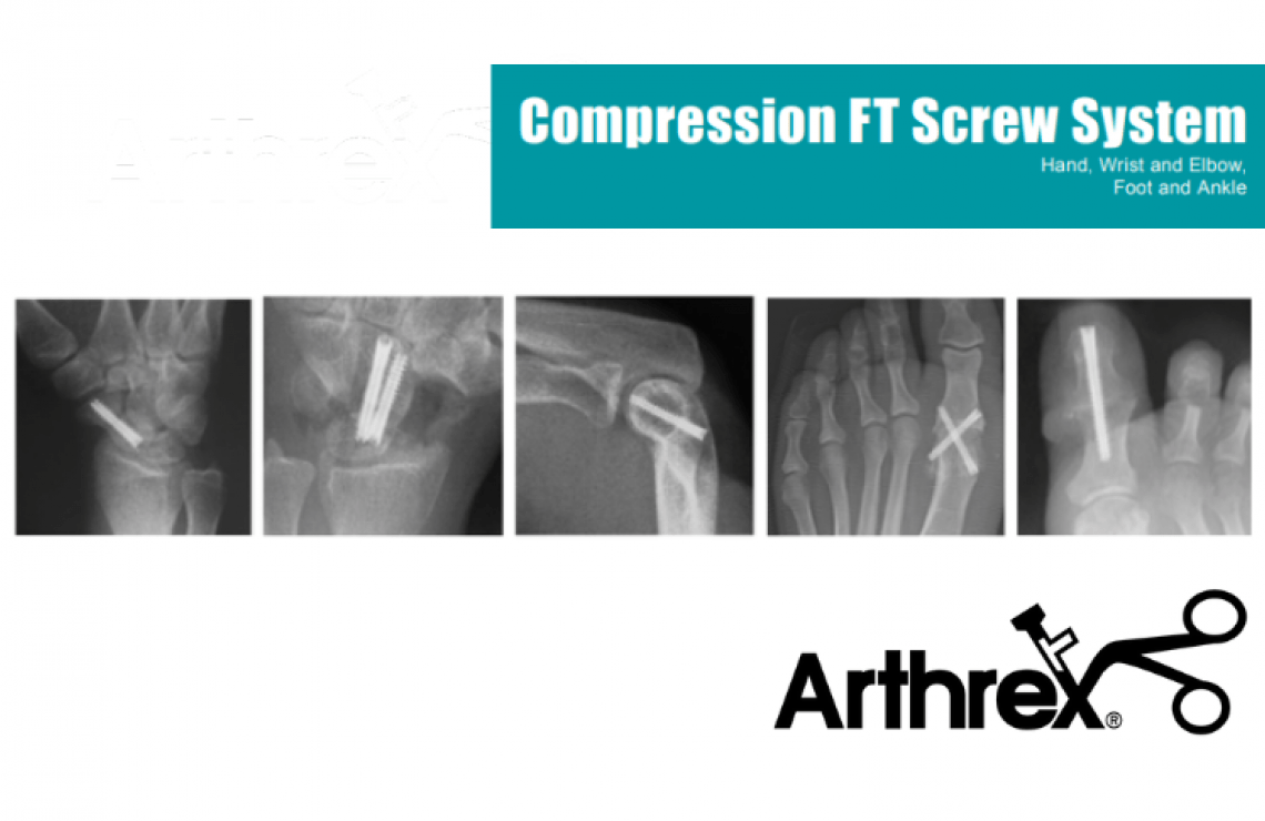 New in the treatment of hand and foot bones - Arthrex Compression FT ...